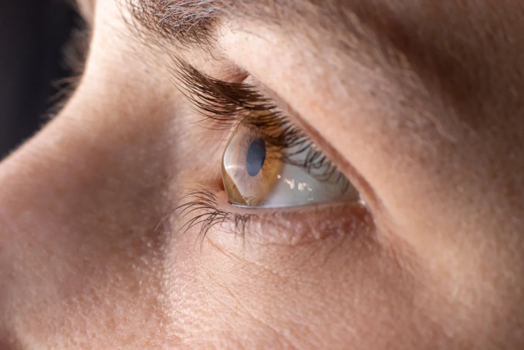 Corneal Diseases - Nova Eye Clinic
